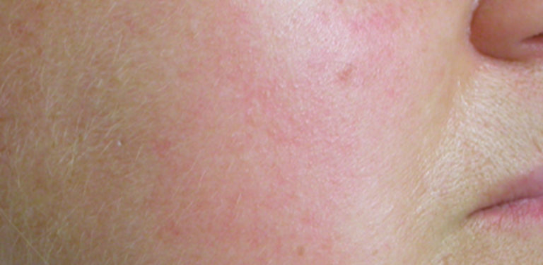 Telangiectasias y rosácea - Dermaclinic