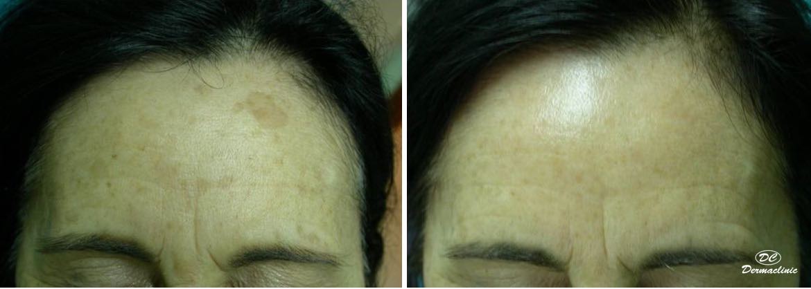 Tratamiento de manchas marrones - Dermaclinic